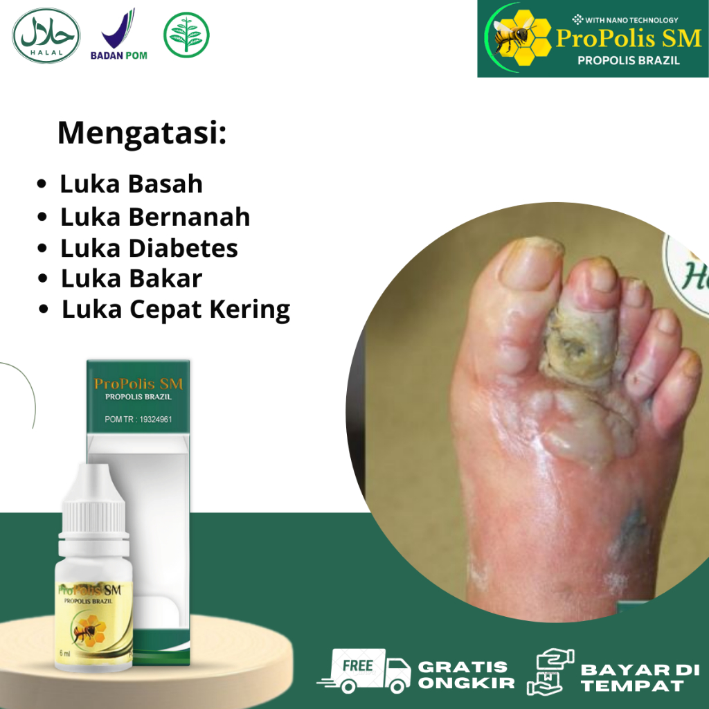 Jual Obat Pengering Luka Basah, Luka Diabetes Bernanah, Luka Bakar ...