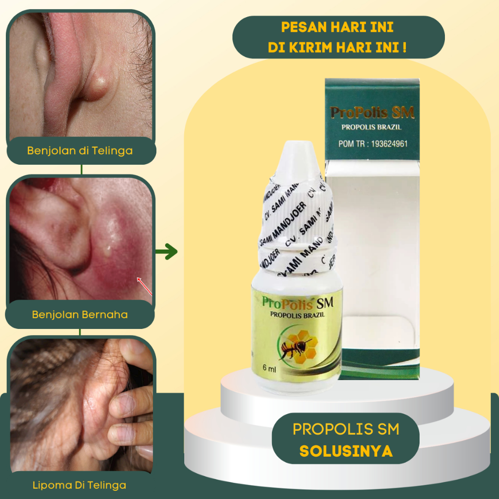 Jual Obat Penghilang Benjolan Di Daun Telinga - Obat Benjolan Di ...