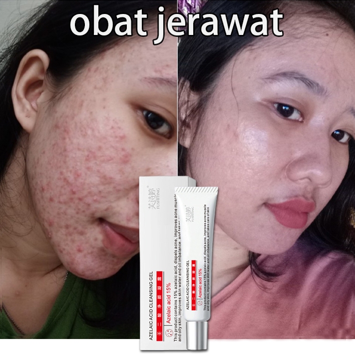Jual Salep jerawat obat jerawat dan bekas jerawat Penghilang Jerawat 20g obat totol jerawat ...