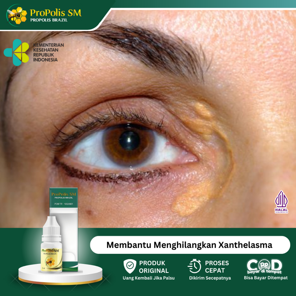 Jual Obat Penghilang Xanthelasma, Obat Penghilang Obat Gumpalan Lemak ...