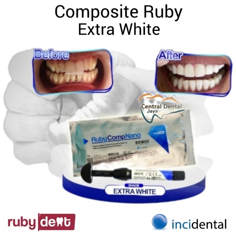 Jual Composite Ruby Comp Nano Veneer Extra White EW (Extra Bleach) / Komposit Veneer Gigi Super ...