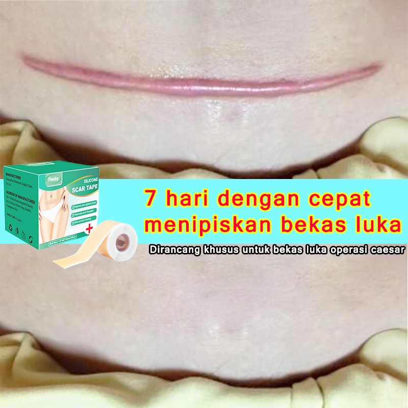 Jual Scar Removal Silicone penghilang keloid bekas caesar Tape ...