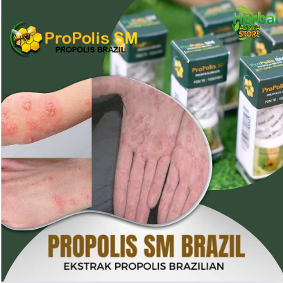 Jual Obat Penghilang Gatal - Gatel scabies pada manusia | Obat Kudis ...