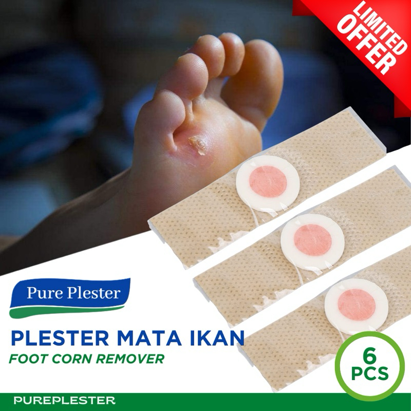 Jual Plester Mata Ikan dan Kutil 6 Pcs - 1 Strip/ Obat Mata Ikan ...