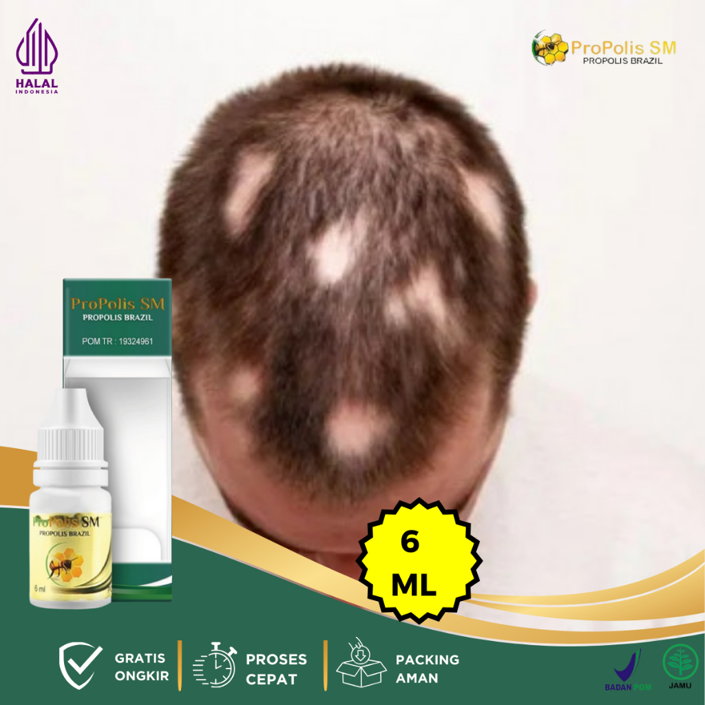 Jual Obat Alopecia Areata Kebotakan Rambut Pada kepala Penumbuh Botak Koin Penumbuh Rambut Pitak ...