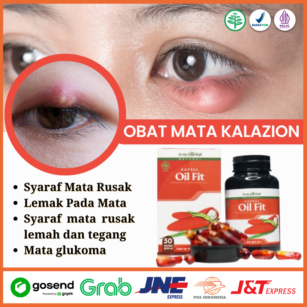 Jual Obat Kalazion, Obat Mata Kalazion Pada Anak Dan Dewasa,TERLARIS ...