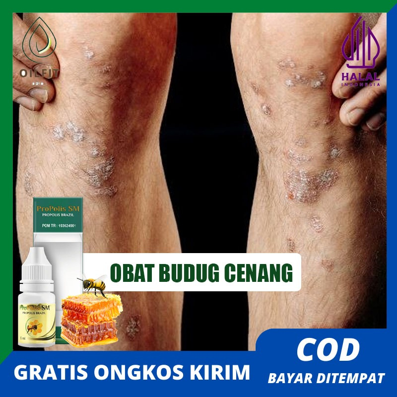 Jual Obat Budug Cenang Bernanah Kulit Gatal Budug Di Kaki Budug Santri ...