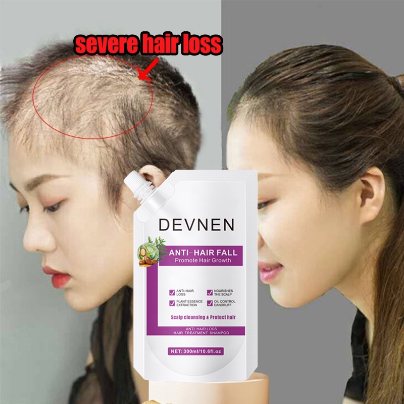 Jual 300ml Anti Rambut Rontok Ketombe Sampo Hair Growth Mengurangi ...