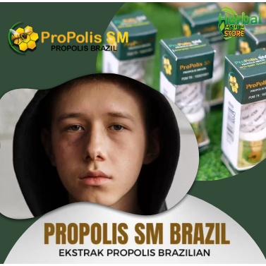 Jual Obat Oles Penghilang Pytiriasis Alba Bercak Putih di Wajah, Herbal ...