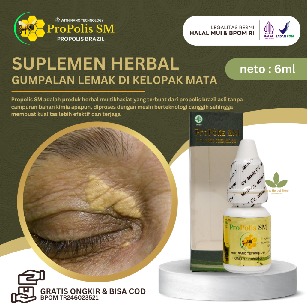 Jual Propolis SM Obat Xanthelasma Penghilang Gumpalan Lemak Di Kelopak ...