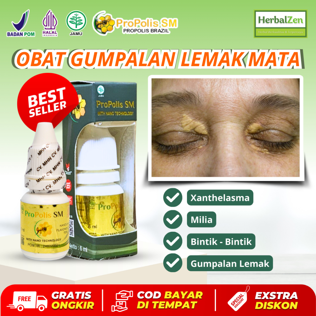 Jual Obat Penghilang Gumpalan Lemak Di Kelopak Mata Xanthelasma Milia ...