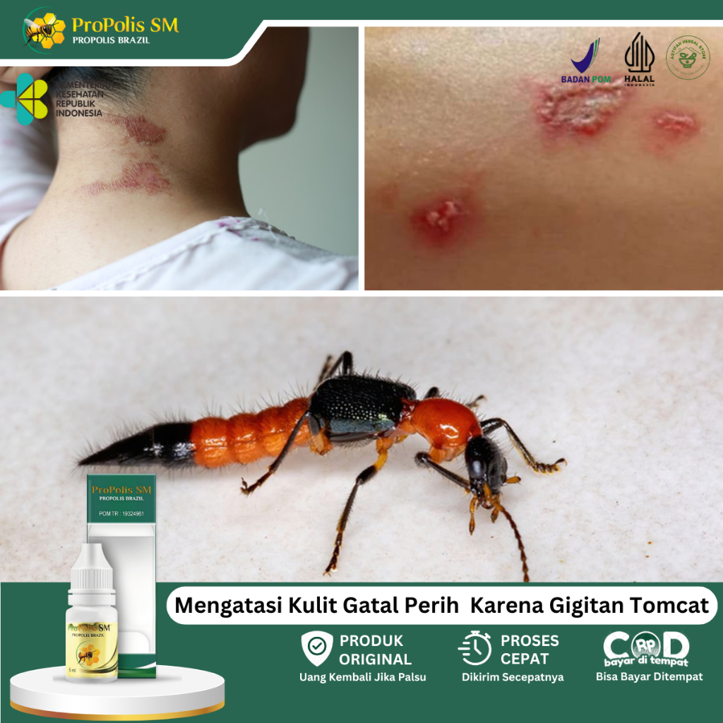 Jual Obat Gigitan Tomcat, Salep Gigitan Serangga, Obat Kulir Melepuh ...