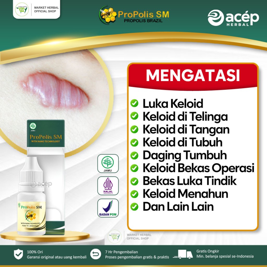 Jual Obat Benjolan Keloid Daging Tumbuh Menahun Bekas Operasi Injeksi Di Dada Tangan Telinga ...