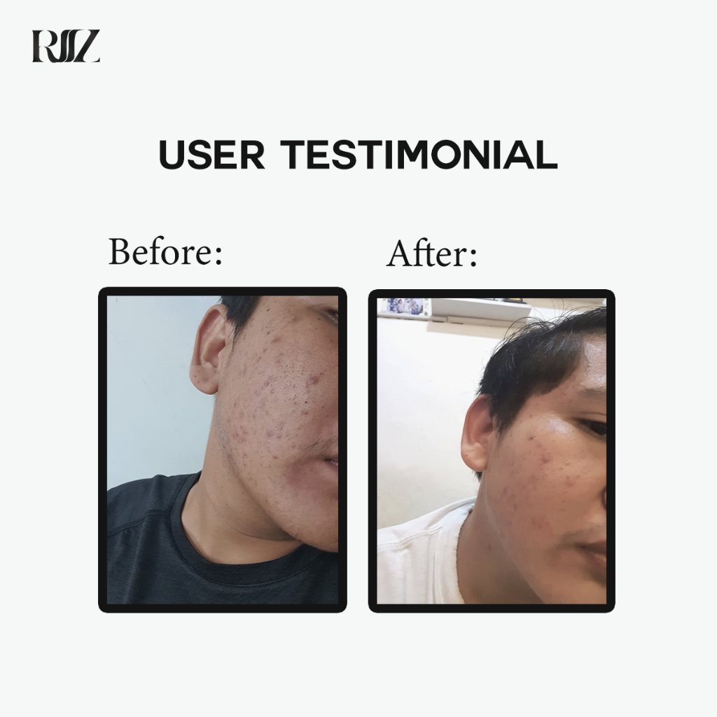 Jual PURIFYING CREAM BY RIIZ | BRIGHTENING AND PURIFYING | Cysteamine ...