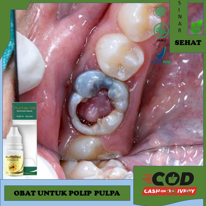 Jual obat polip pulpa Obat Polip Gigi Propolis SM - Obat Polip gigi ...