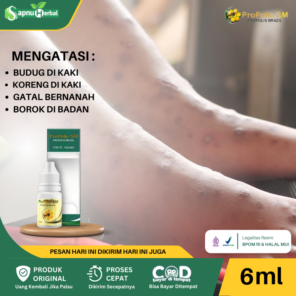 Jual Obat Budug Di Kaki, Obat Penghilang Bekas Budug Di Kaki Tangan ...