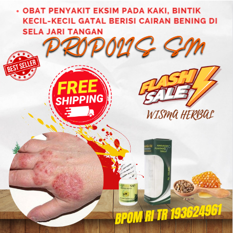 Jual Obat penyakit eksim pada kaki, Bintik kecil-kecil gatal berisi ...
