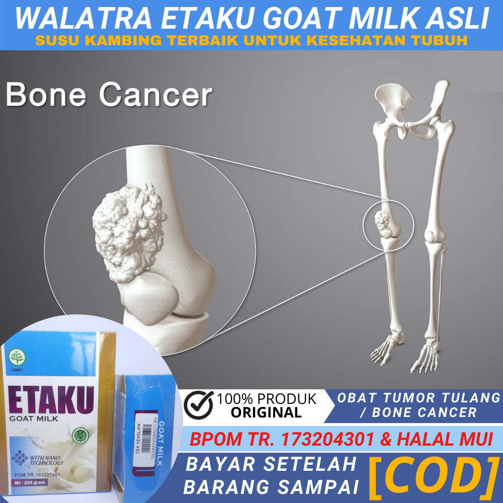 Jual Obat Tumor Tulang, Kanker Tulang, Benjolan Tulang, Bone tumor ...