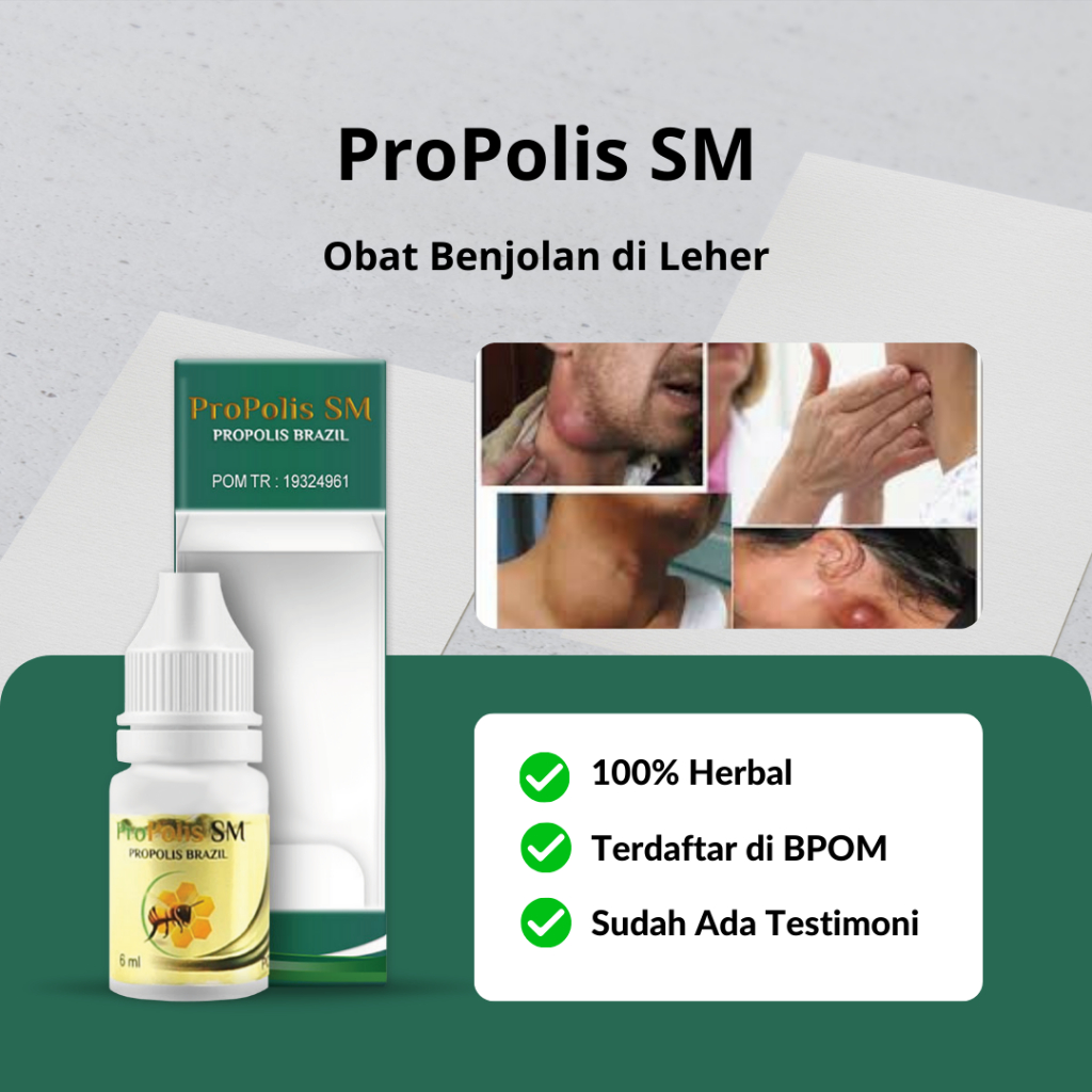 Jual Propolis SM - Obat Benjolan di Leher, Obat Pengempes Benjolan ...