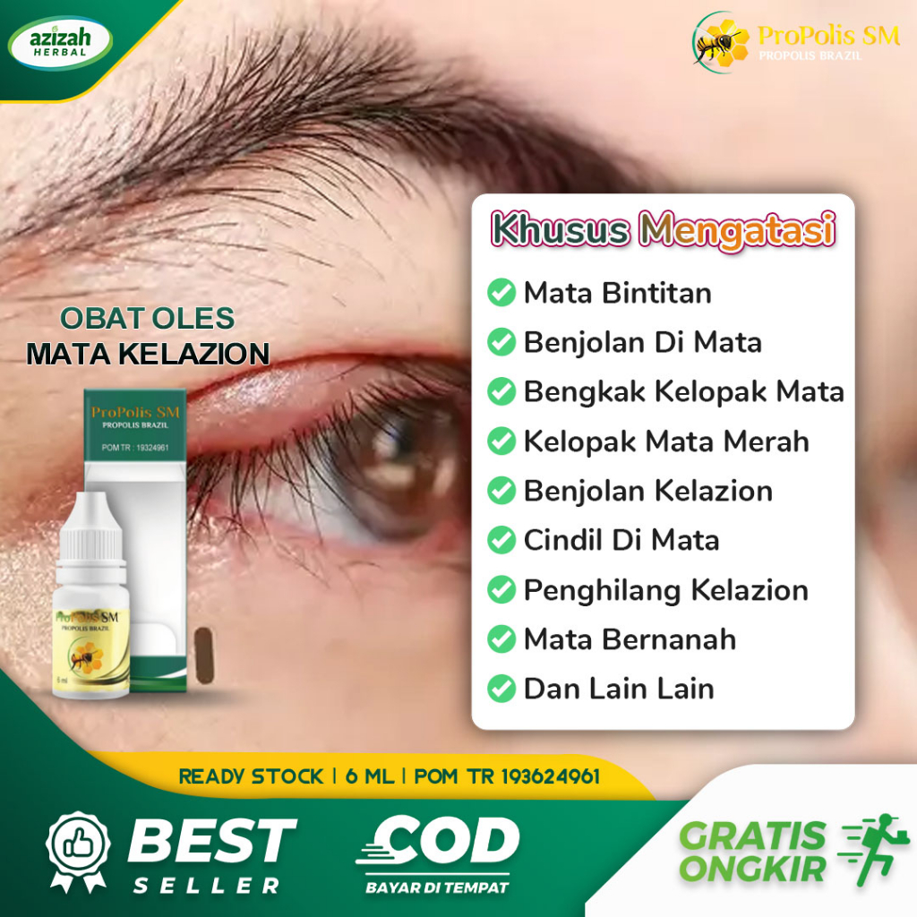 Jual Obat Benjolan Di Kelopak Mata Kalazion Bintitan Kelopak Mata ...