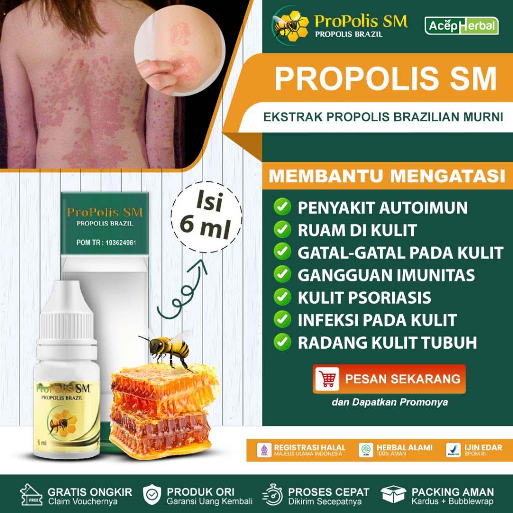 Jual Obat autoimun lupus psoriasis kelainan daya tahan tubuh mengatasi ...