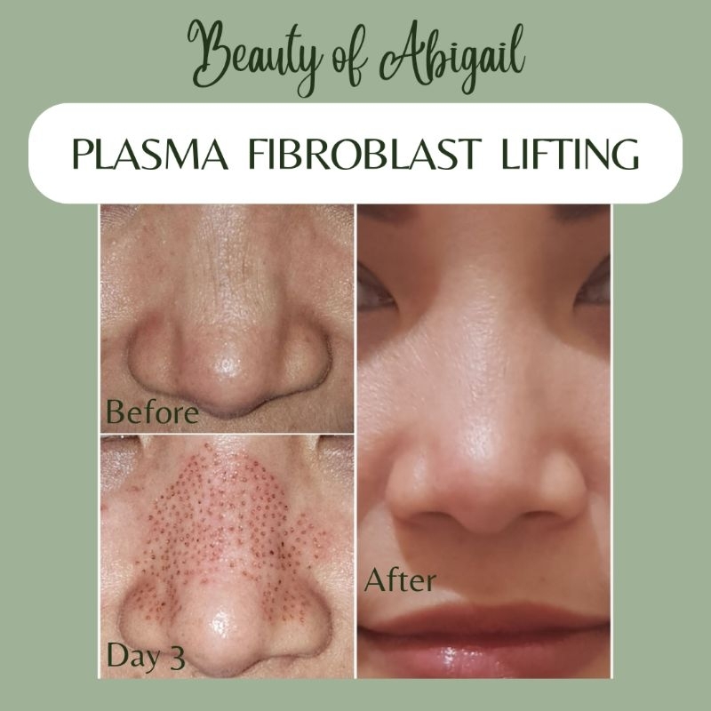Jual Plasma Fibroblast Lifting / Plasma Lifting Treatment | Shopee Indonesia