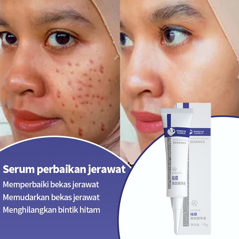 Jual Salep jerawat Obat jerawat dan bekas jerawat Penghilang bekas ... Jual Salep jerawat Obat jerawat dan bekas jerawat Penghilang bekas ...