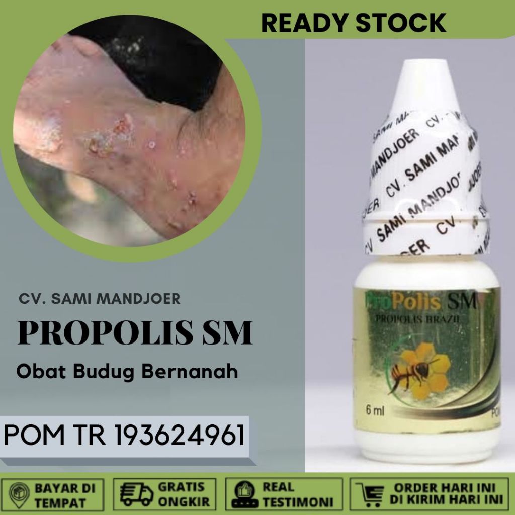 Jual Obat Budug, Budug Bernanah di kaki, Budug Bernanah Di Tangan, Obat ...