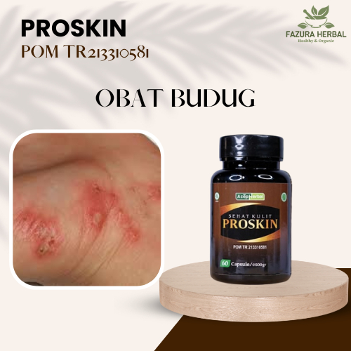 Jual Obat Budug, Obat Jamur, Obat Campak, Obat Kudis, Obat Bruntusan Di ...