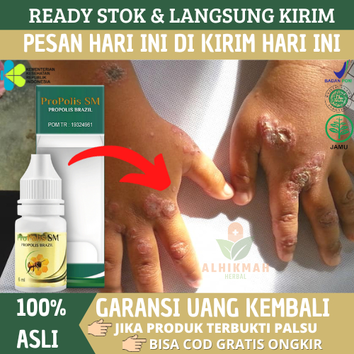 Jual Obat Budug Di Kaki / Tangan, Obat Gatal Borok Budug Kudis Scabies ...
