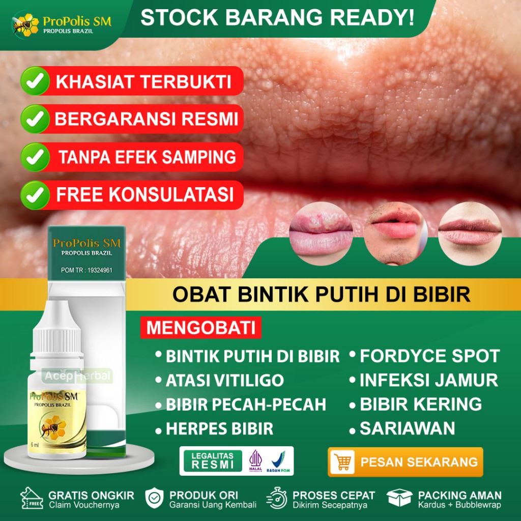 Jual Obat Bintik Putih Di Bibir Mengatasi Vitiligo Bibir Pecah-pecah ...