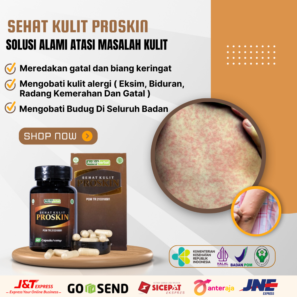 Jual Obat Biduran Alergi Dingin Dan Panas Menahun Kronis Kaligata Gatal ...