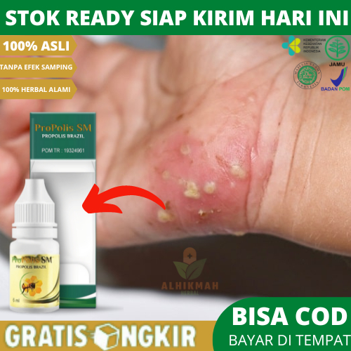 Jual Obat Borok Budug Di Tangan / Telapak Tangan, Obat Budug Di Jari ...