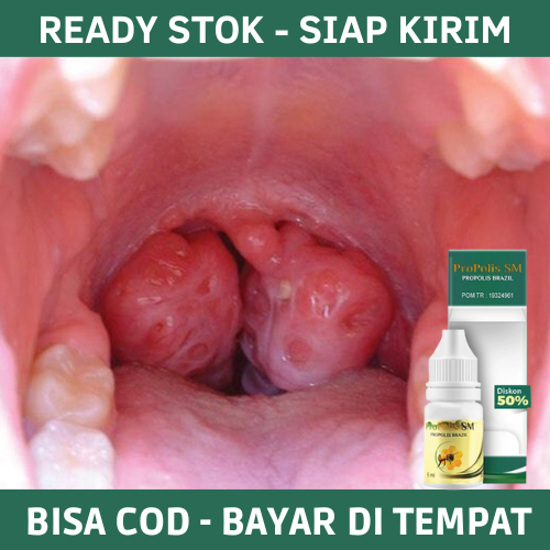 Jual Obat Amandel Dewasa, Amandel Anak, Amandel dan Radang Tenggorokan ...