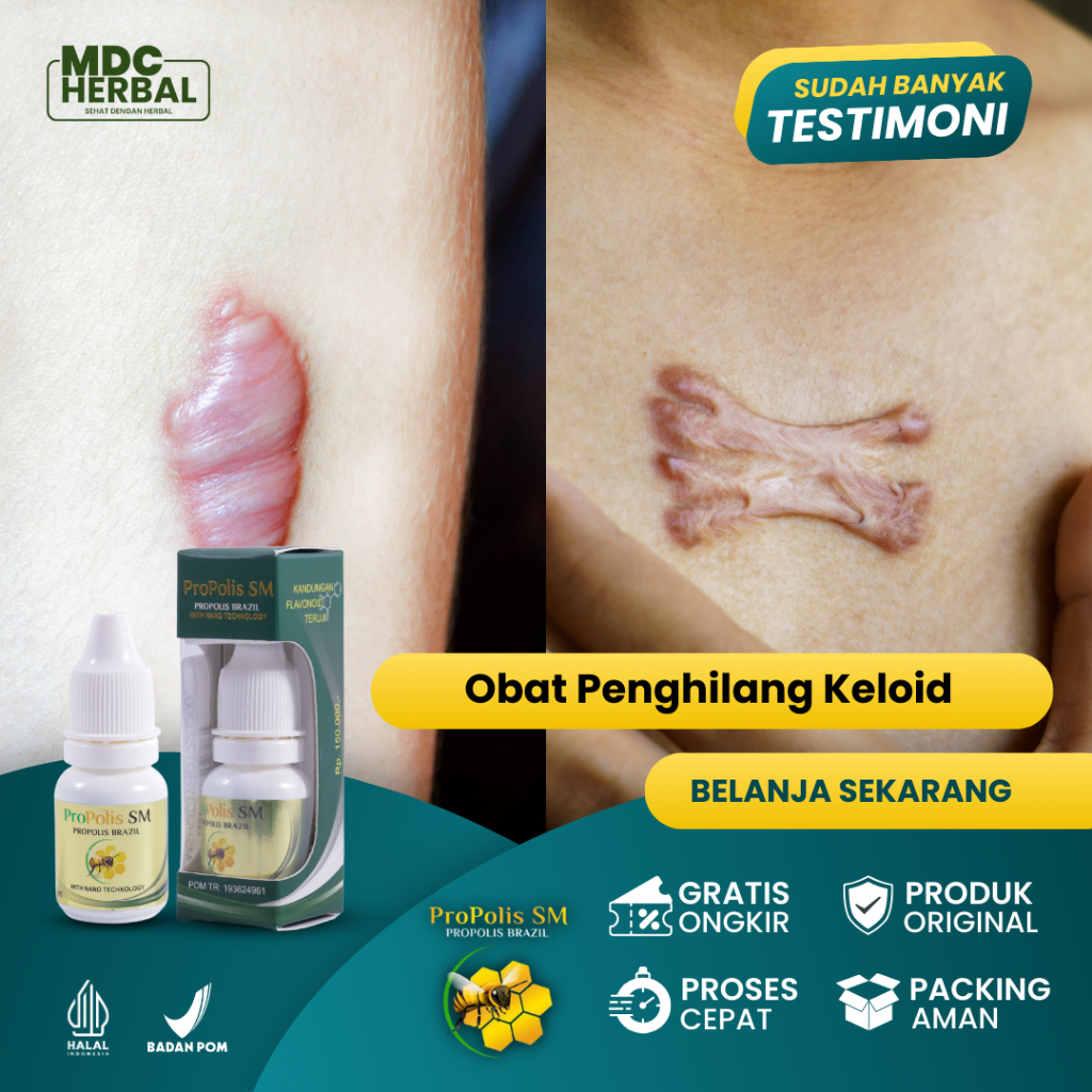 Jual Obat Penghilang Keloid Tumbuh Daging Jadi Keloid Luka Tindik Bekas Operasi dengan Propolis ...