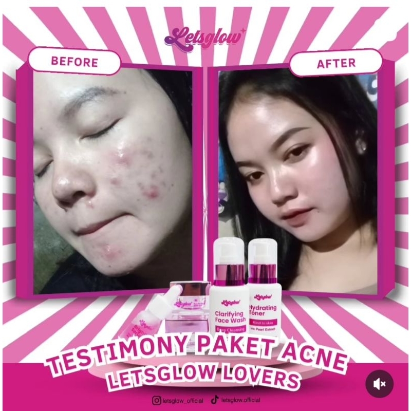 Jual Paket Acne LETS GLOW VIRAL | Shopee Indonesia