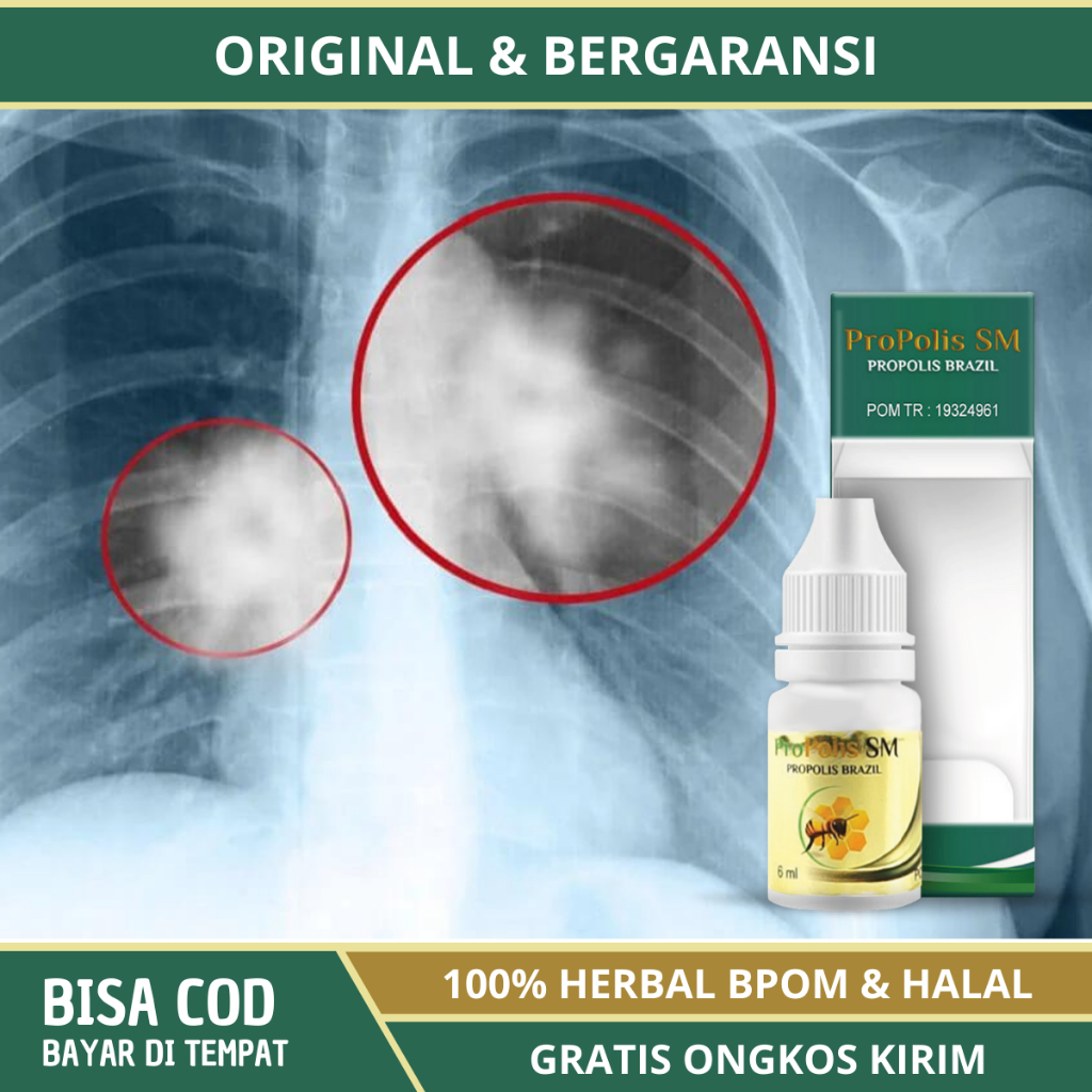 Jual Obat Flek Paru Paru, Obat TBC Paru, Obat Pneumonia, Obat Radang ... Jual Obat Flek Paru Paru, Obat TBC Paru, Obat Pneumonia, Obat Radang ...