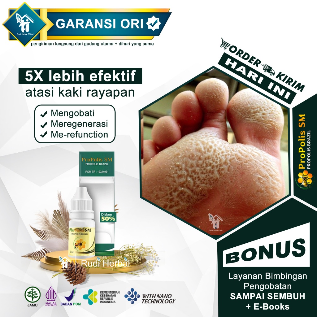 Jual Obat Oles Kaki Rayapan Pitted Keratolisis Telapak Kaki Bolong ...