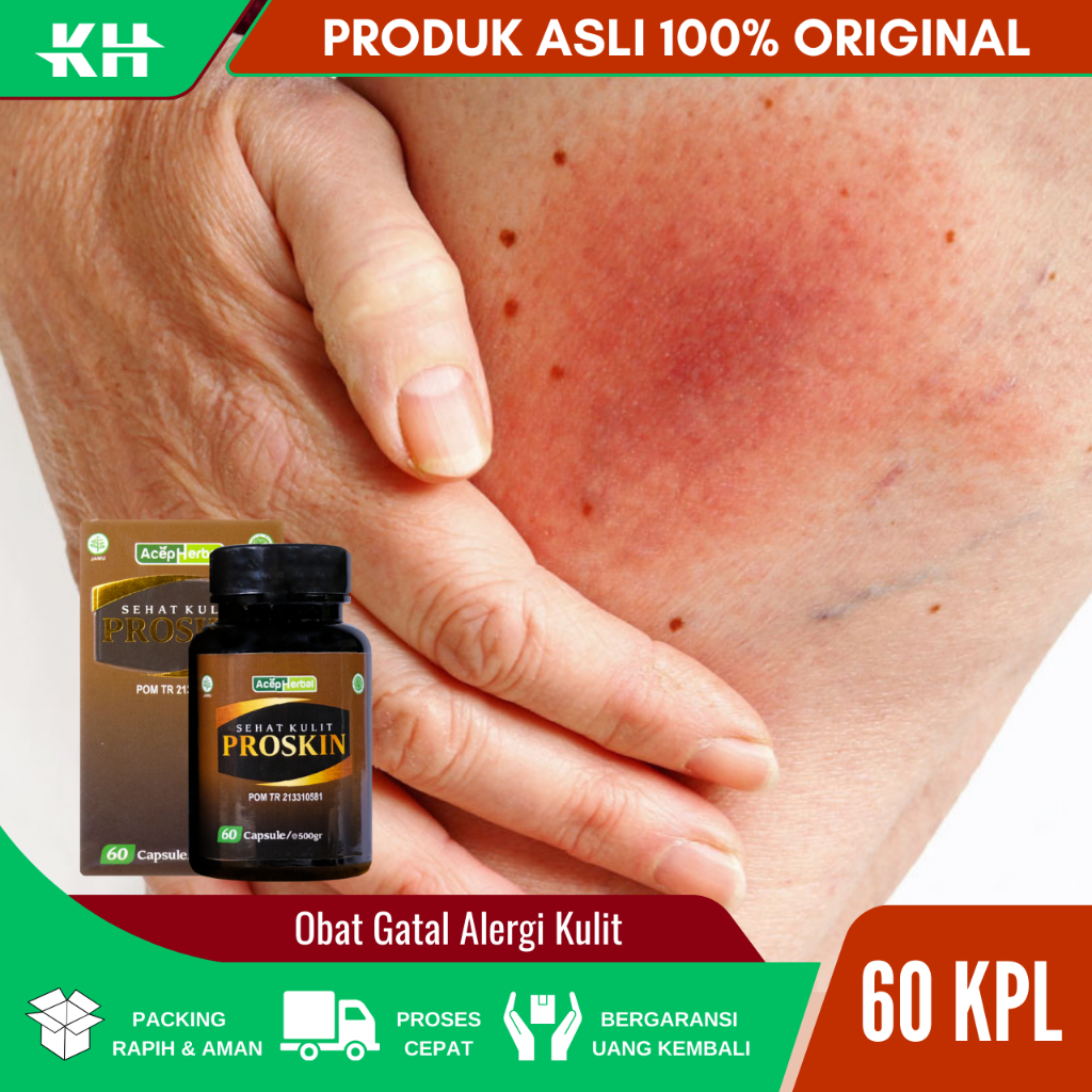 Jual Obat Gatal Kulit Alergi Gatal Jamur Kulit Kudis Kurap Panu ...