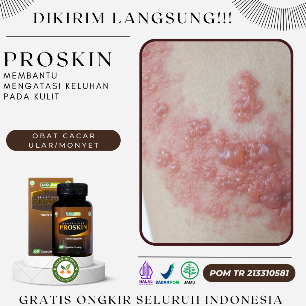Jual Proskin 100% Original - Obat Cacar Ular, Cacar Monyet, Penghilang ...
