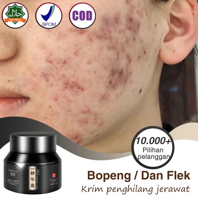 Jual Cream Penghilang Bekas Jerawat | Bopeng,dan Flek | penghilang ...