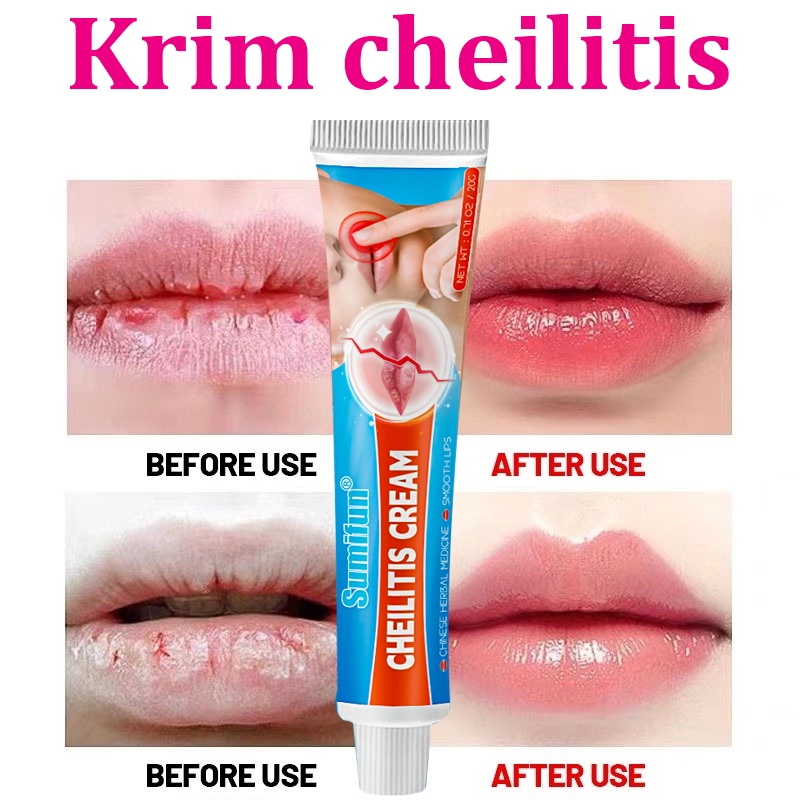Jual Cheilitis cream bibir moisturizing pelembab bibir peradangan kulit ...