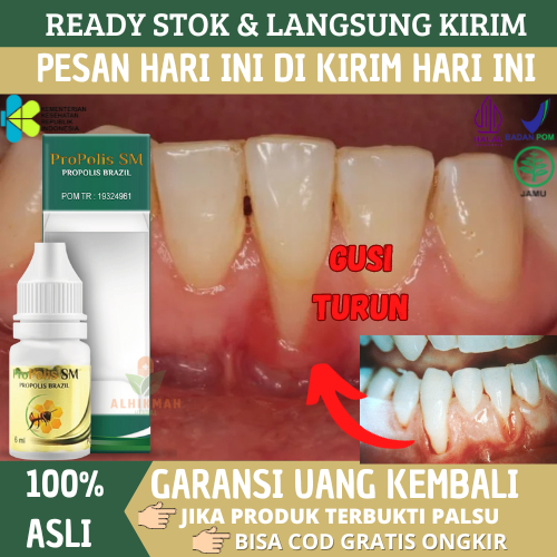 Jual Obat Resesi Gingiva Periodontitis / Gusi Turun, Obat Gigi Turun ...