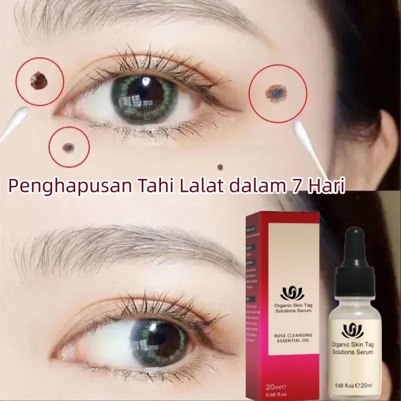 Jual Penghilang Tahi Lalat Penghilang Kutil Skin Tag Remover Serum ...