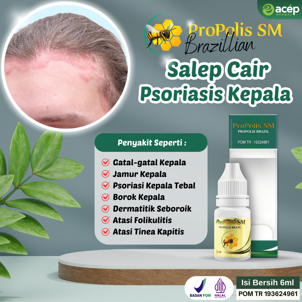 Jual Obat Psoriasis Radang Kulit Bersisik Vulgaris Gutata Wajah Ruam ...
