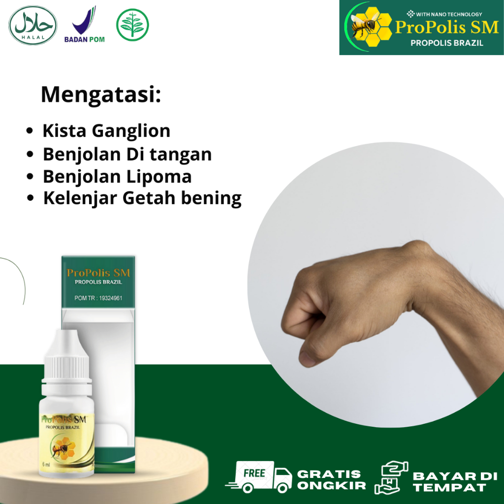 Jual Obat Kista Ganglion, Benjolan Di Tangan, Benjolan Lipoma ...