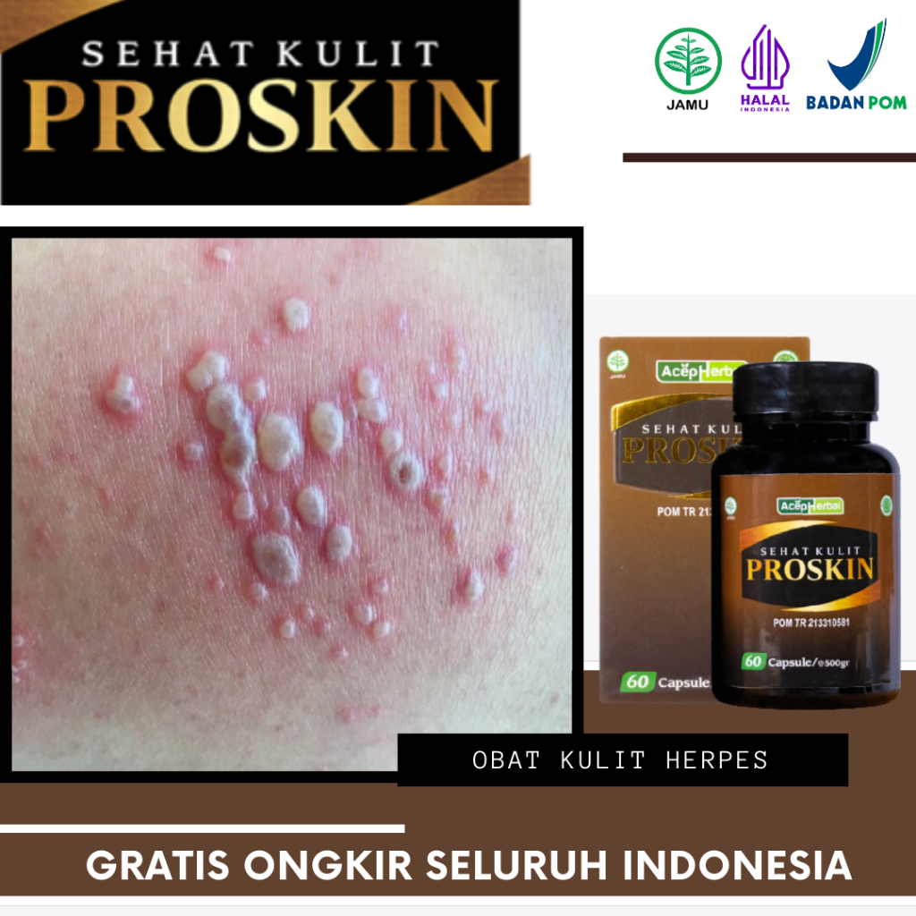 Jual Proskin - Obat Gatal Kulit Herpes, Herpes Genital, Herpes Simplex ...