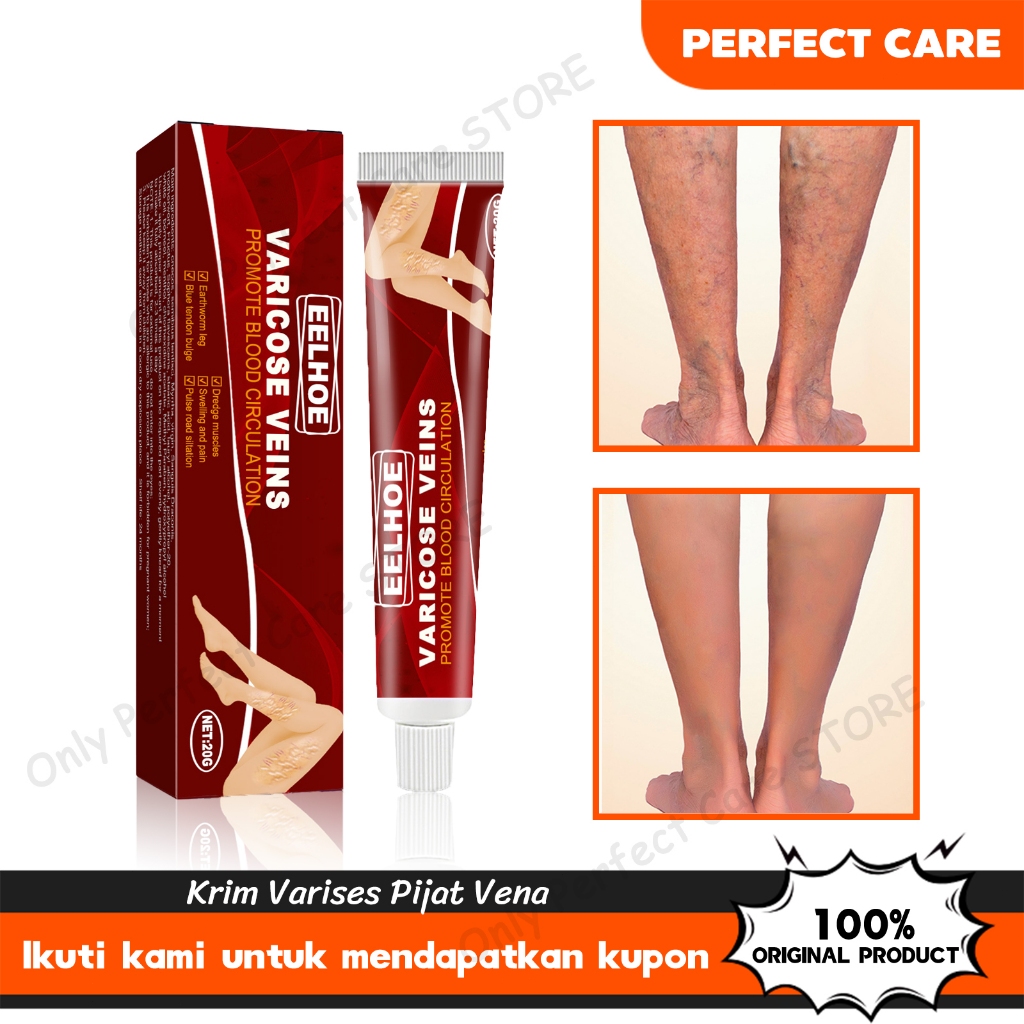 Jual EELHOE Varicose Veins Cream 20g Varicose Vein Repair Cream Obat ...