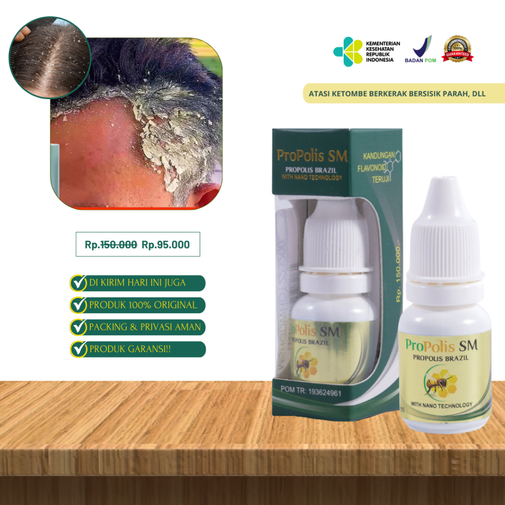 Jual Obat Ketombe, Obat Ketombe Parah Berkerak Bersisik, Obat Seboroik, Cradle cap, Obat ...