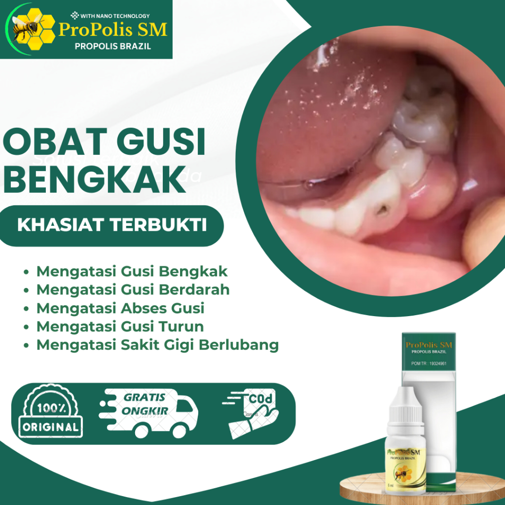 Jual Obat Gusi Bengkak, Gusi Berdarah, Gusi Turun, Abses Gusi, Gusi ...